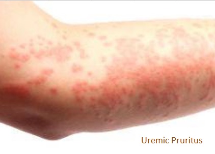 Uremic Pruritus Chronic Kidney Disease Associated Pruritus: From