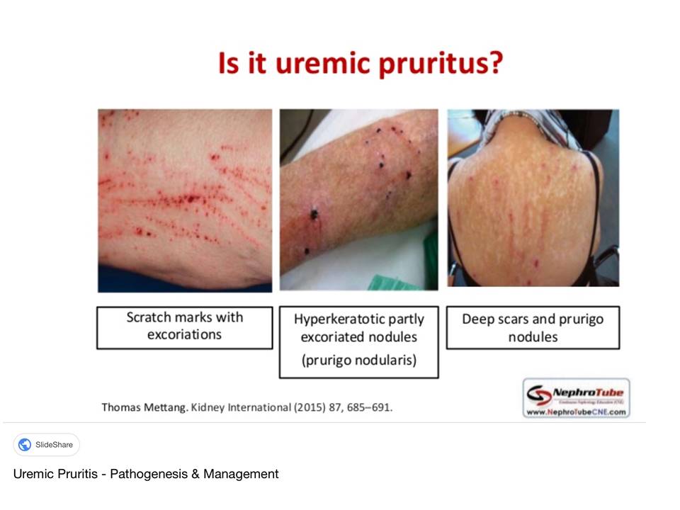 Skin & Atypical HUS: Thrombotic Microangiopathy in aHUS - aHUS Alliance ...